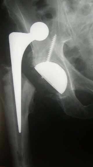 Reviews of the Stryker Exeter Hip